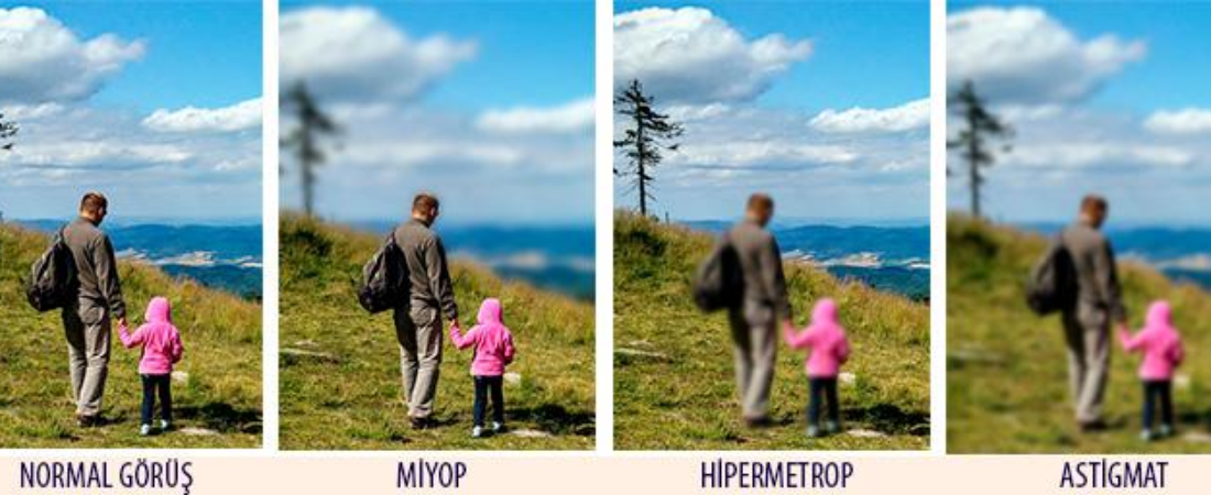 Astigmat | Astigmat nedir? | Hermoda Gözlük